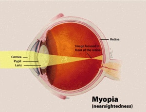 Know your medical terms: Myopia | TheHealthSite.com