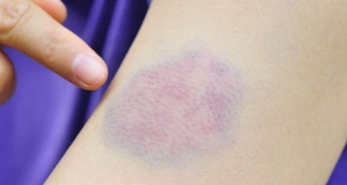 What could be the reason behind those bruises? TheHealthSite.com ...
