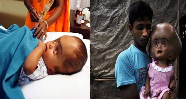 Baby Roona's head now reduced to 57 cm after several surgeries ...