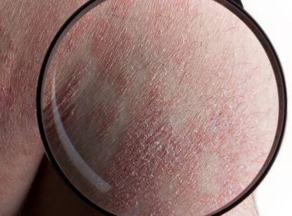Psoriasis - symptoms, triggers, treatment and management ...