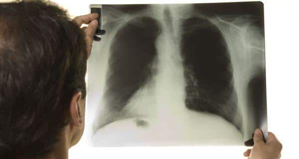Complications of tuberculosis you should know about | TheHealthSite.com