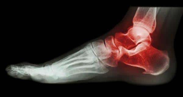 Acute gout attacks experienced most commonly at night | TheHealthSite.com