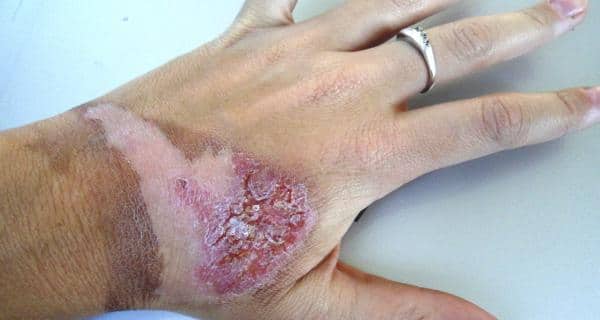 इन 8 घरेलु उपचारों से जले हुए निशान को मिटायें | TheHealthSite.com Hindi