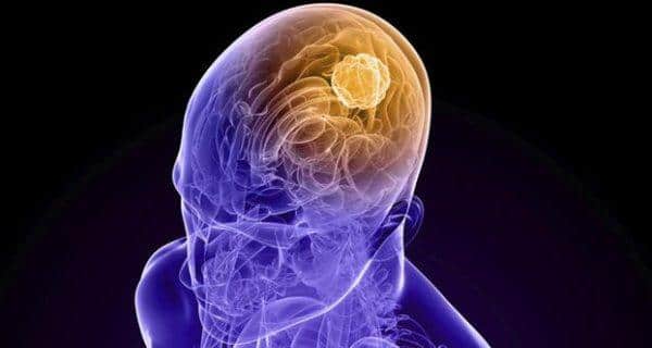 Whole-brain radiation to cure brain cancer causes memory loss: Study ...