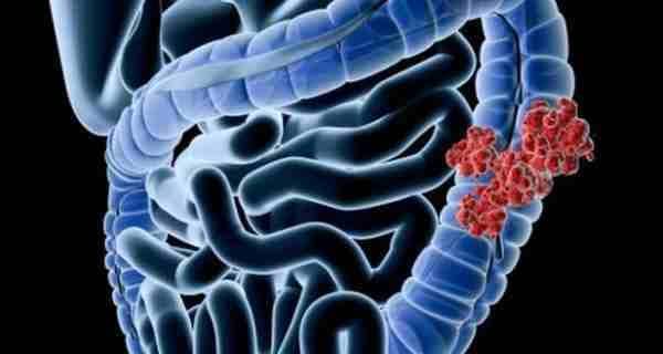 Colon cancer -- a two drug combination reduces risk by 67% ...