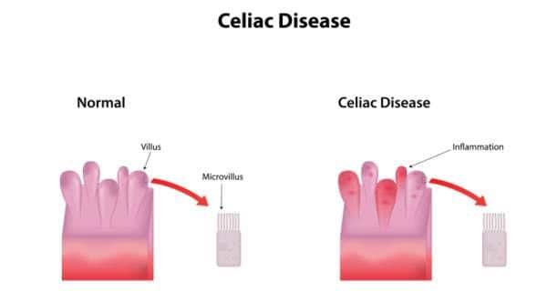 Celiac disease - Health Tips, Celiac disease Health Articles, Health ...