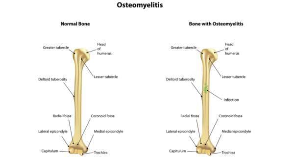 Osteomyelitis - Health Tips, Osteomyelitis Health Articles, Health News ...