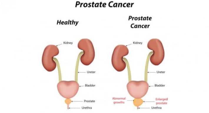 Prostate cancer - Health Tips, Prostate cancer Health Articles, Health ...