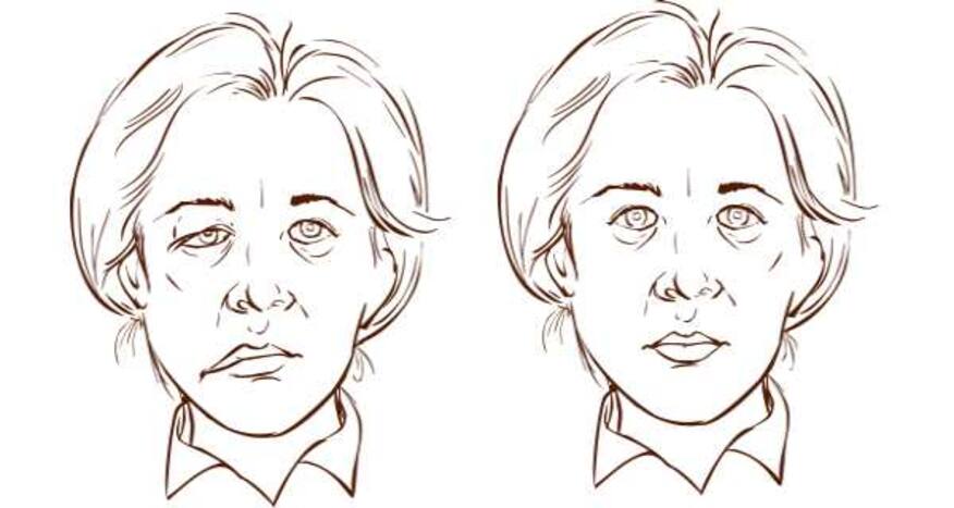 7 symptoms of a stroke you should not ignore | TheHealthSite.com