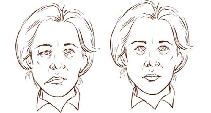 7 symptoms of a stroke you should not ignore | TheHealthSite.com