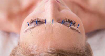 Acupuncture -- all you need to know | TheHealthSite.com