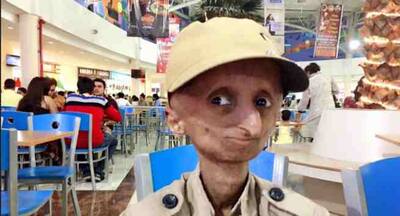 What is it like to raise a kid with progeria in India | TheHealthSite.com