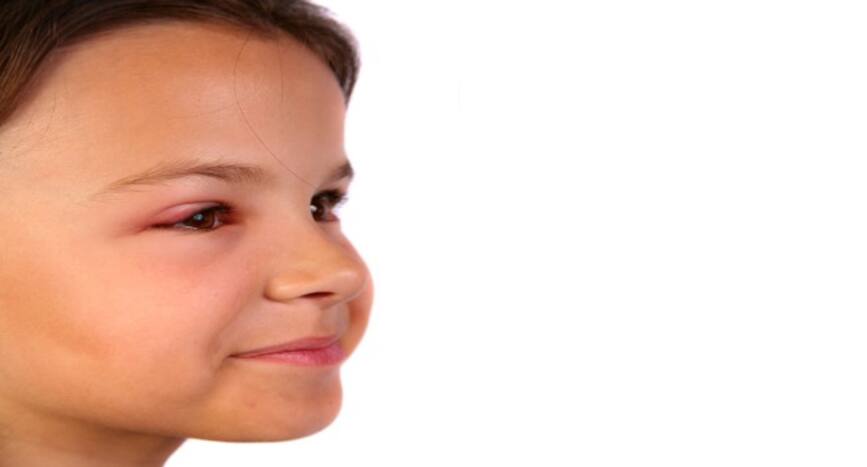 Different types of swelling you shouldn't ignore | TheHealthSite.com