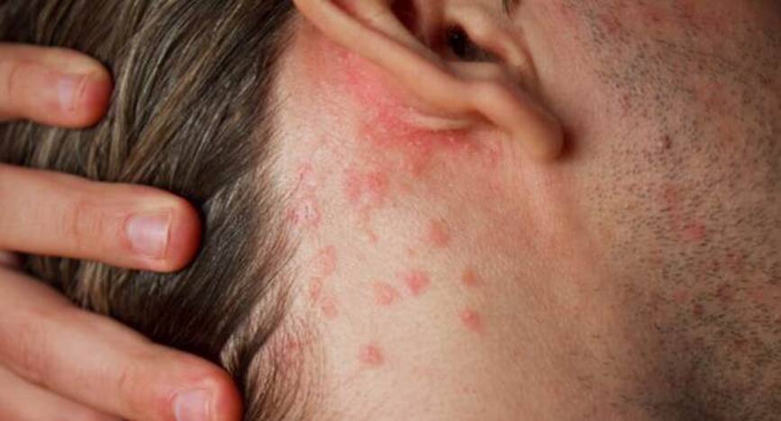 7 side effects of dandruff you MUST know! | TheHealthSite.com