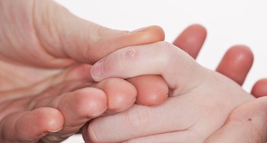 5 signs and symptoms of Human Papilloma Virus (HPV) you MUST be aware ...