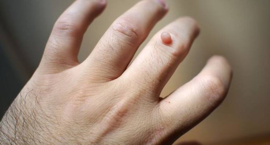 7 types of warts you should be aware of! | TheHealthSite.com