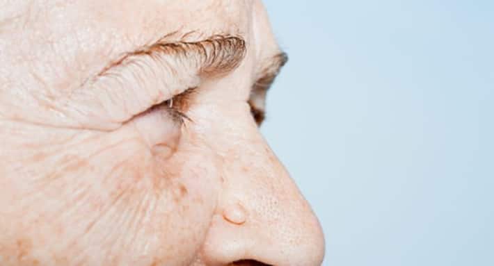 7 types of warts you should be aware of! | TheHealthSite.com