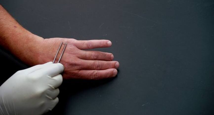 7 types of warts you should be aware of! | TheHealthSite.com