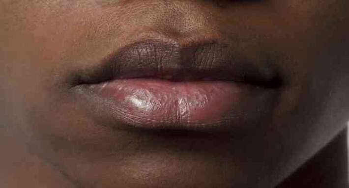 Weight loss, fatigue +3 signs and symptoms of Addison’s disease ...