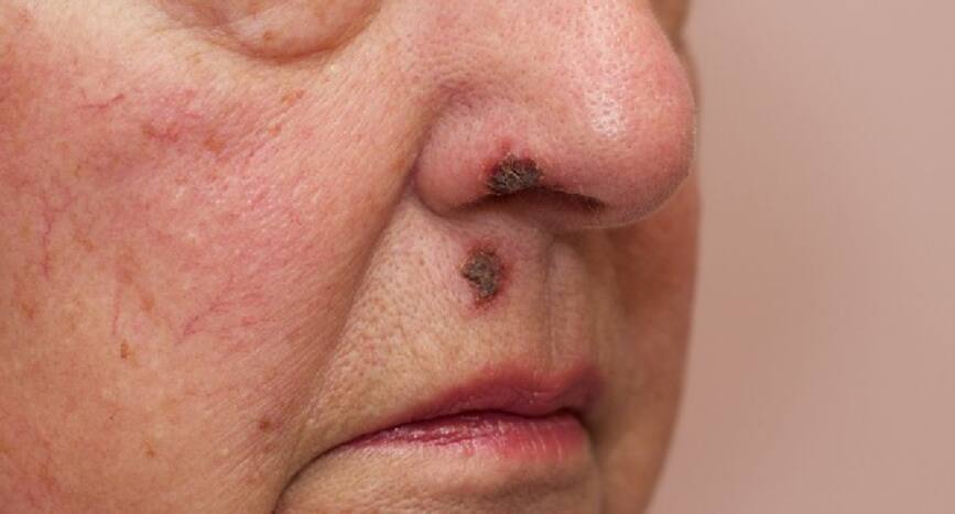 8 highly contagious skin diseases that you should be aware of ...