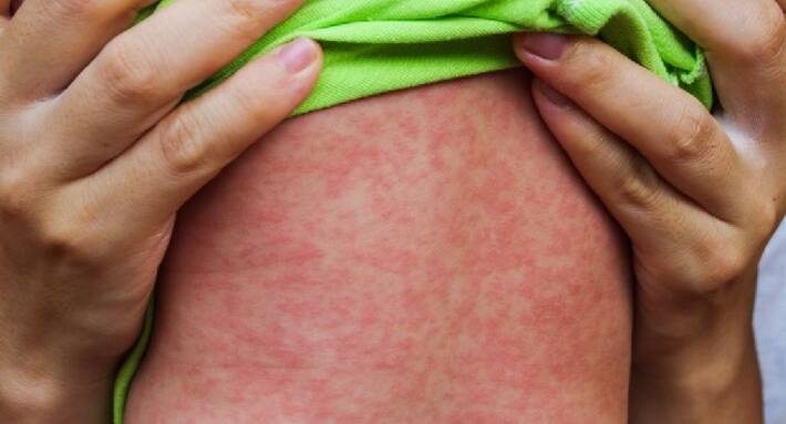8 highly contagious skin diseases that you should be aware of ...