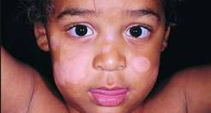 10 reasons of white patches or spots on your skin | TheHealthSite.com