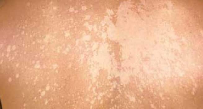 10 reasons of white patches or spots on your skin | TheHealthSite.com