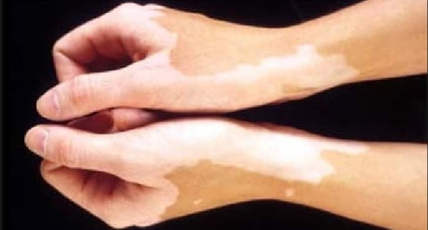 10 reasons of white patches or spots on your skin | TheHealthSite.com