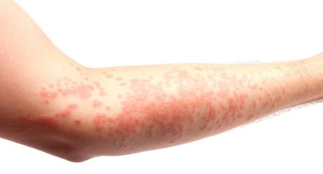 5 reasons you could be breaking out in hives | TheHealthSite.com