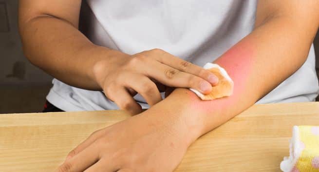 A new method to grow new skin from tissue developed, helpful for burn ...