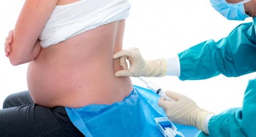 Everything you need to know about epidural explained by an expert ...