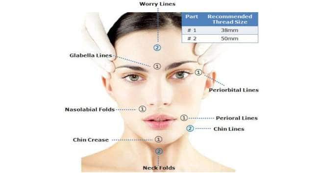 Thread lifts -- everything you need to know about this cosmetic ...