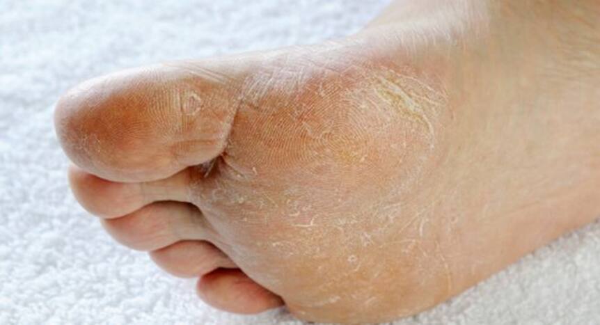 Signs and symptoms of 6 common feet problems | TheHealthSite.com