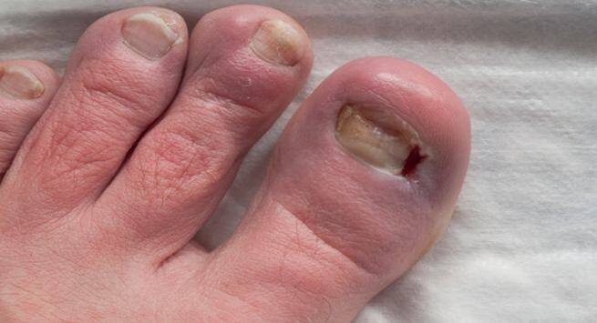 Signs and symptoms of 6 common feet problems | TheHealthSite.com