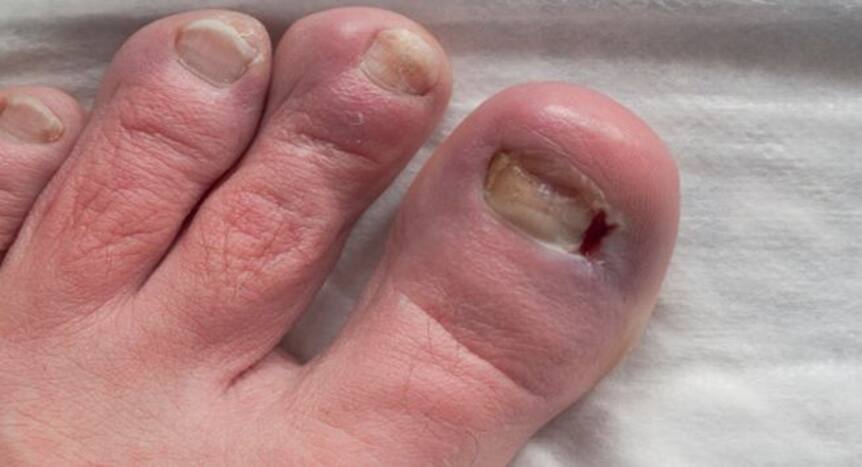 Signs and symptoms of 6 common feet problems | TheHealthSite.com