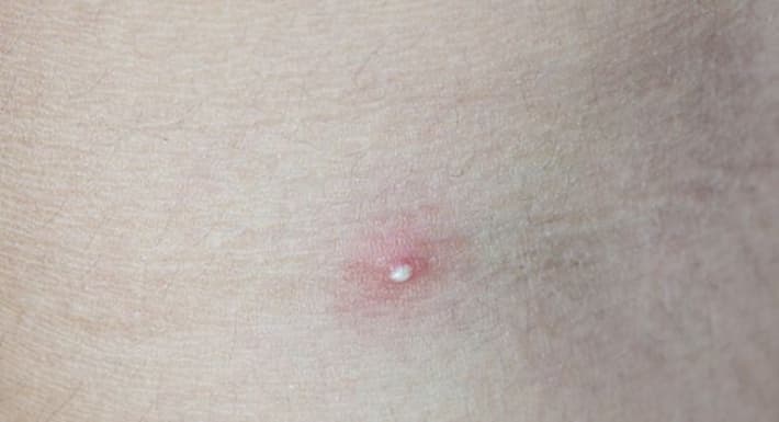 6 types of bumps you should NEVER squeeze or pop | TheHealthSite.com