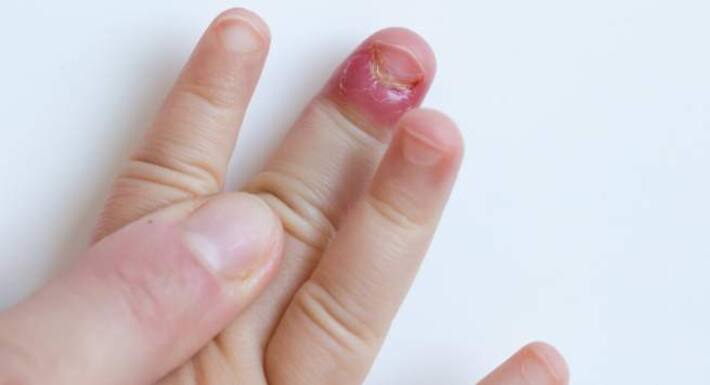8 shocking things that happen when you bite your nails | TheHealthSite.com