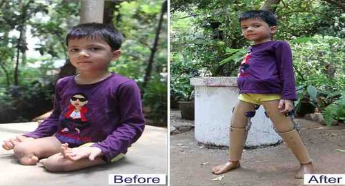 Abdul Khan was born without legs but can now walk and jump with Jaipur ...
