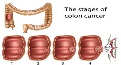 Triclosan tied to colon cancer | TheHealthSite.com