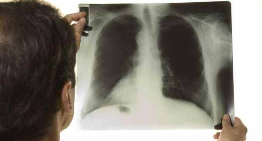 Tuberculosis of the lymph nodes: heres what you need to know ...