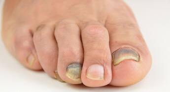 Here's why your toenails are black | TheHealthSite.com