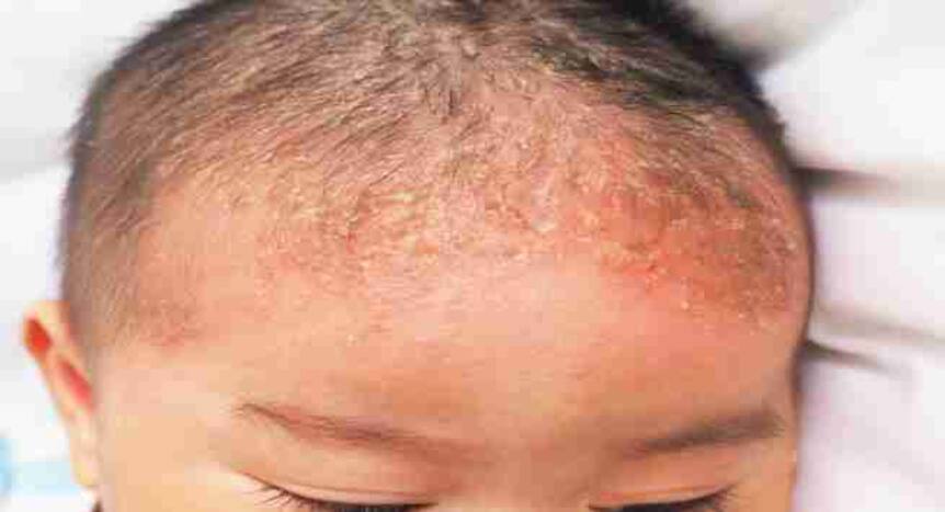 7 common causes of chronic itchy scalp | TheHealthSite.com