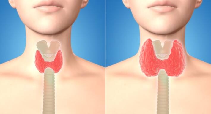 Thyroid cancer: Timely diagnosis and treatment is the key ...