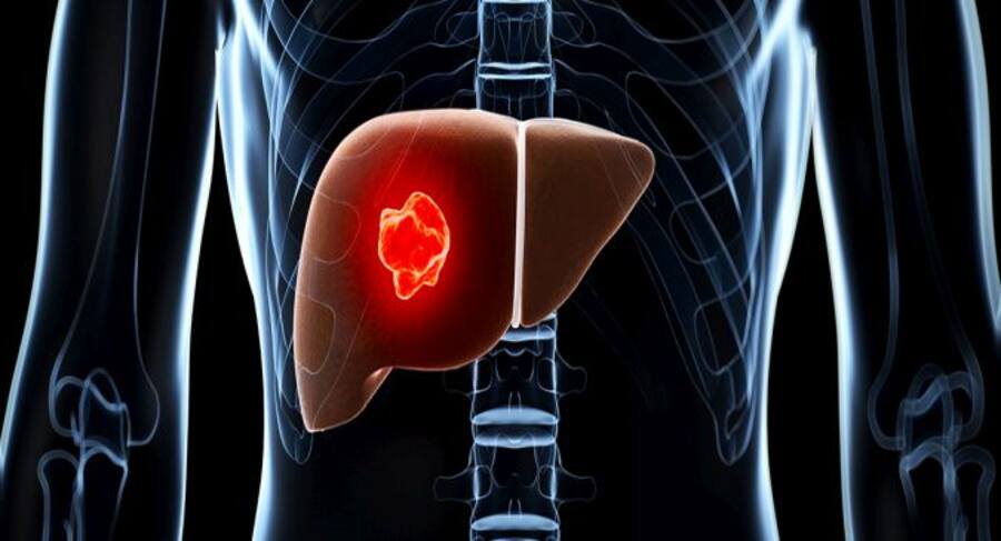New focused radiotherapy a boon for liver cancer patients ...