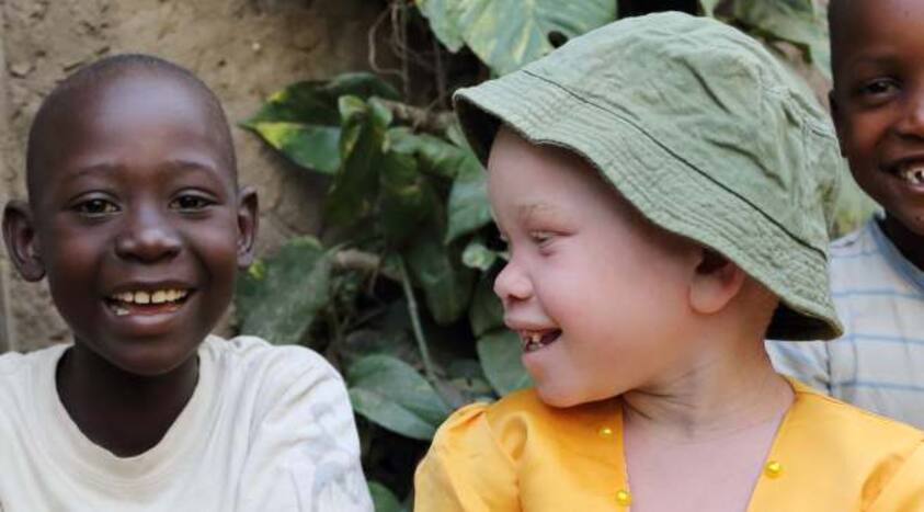 International Albinism Awareness Day: 9 important facts about albinism ...