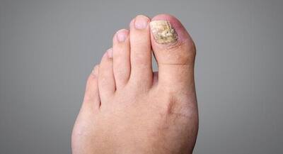 Here's what you should do if your nails fall off | TheHealthSite.com