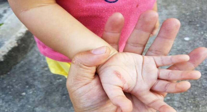 5 things you should NEVER apply on burns | TheHealthSite.com