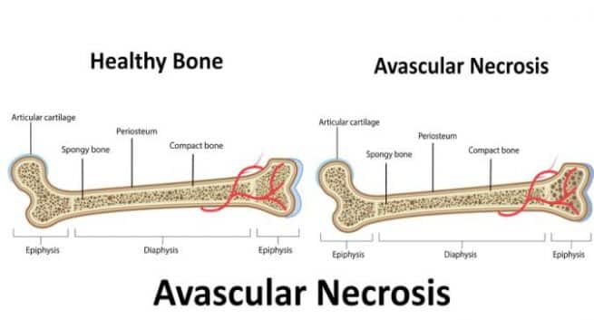 What is Avascular Necrosis (AVN)? | TheHealthSite.com