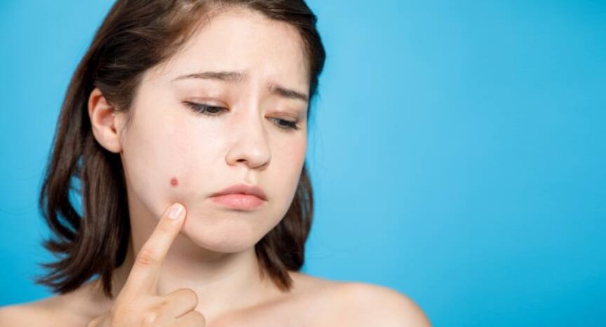 Bra strap, tight underwear +more shocking causes of acne ...