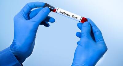 Blood tests for arthritis -- what you need to know | TheHealthSite.com
